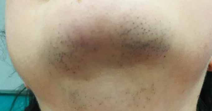 Do you want to get rid of unsightly hairs on your face? Here is an easy ...