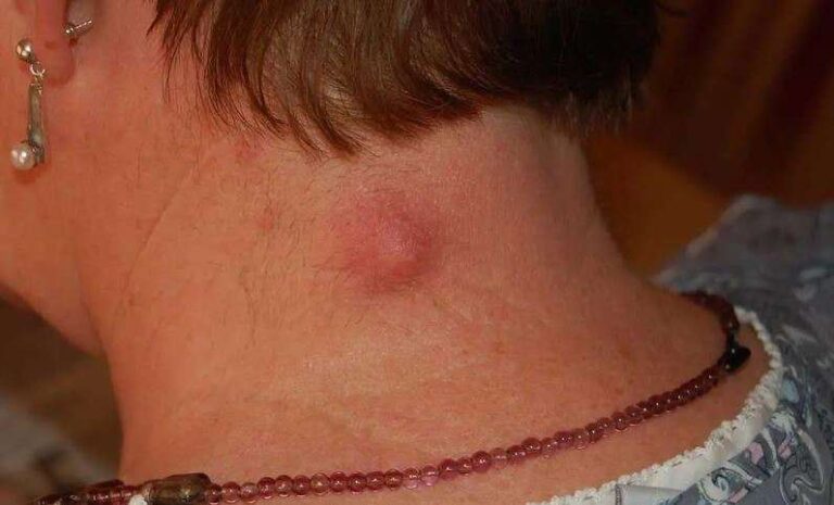 Have you ever had a similar lump on your neck? If so, you should ...