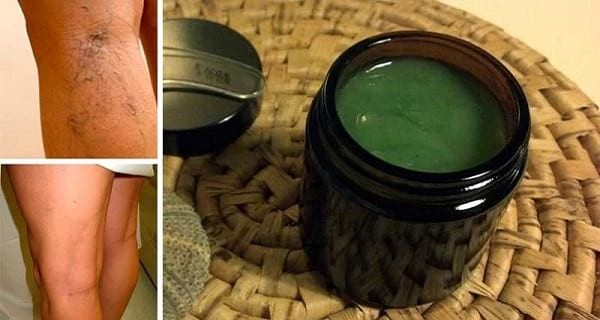 Old wives' remedy that helps with unsightly varices and varicose veins ...