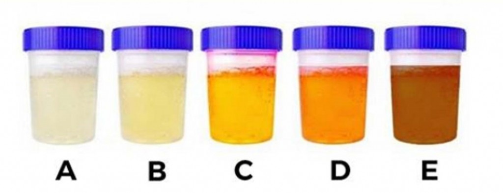 Don't ignore the color of your urine; it can say a lot about your ...