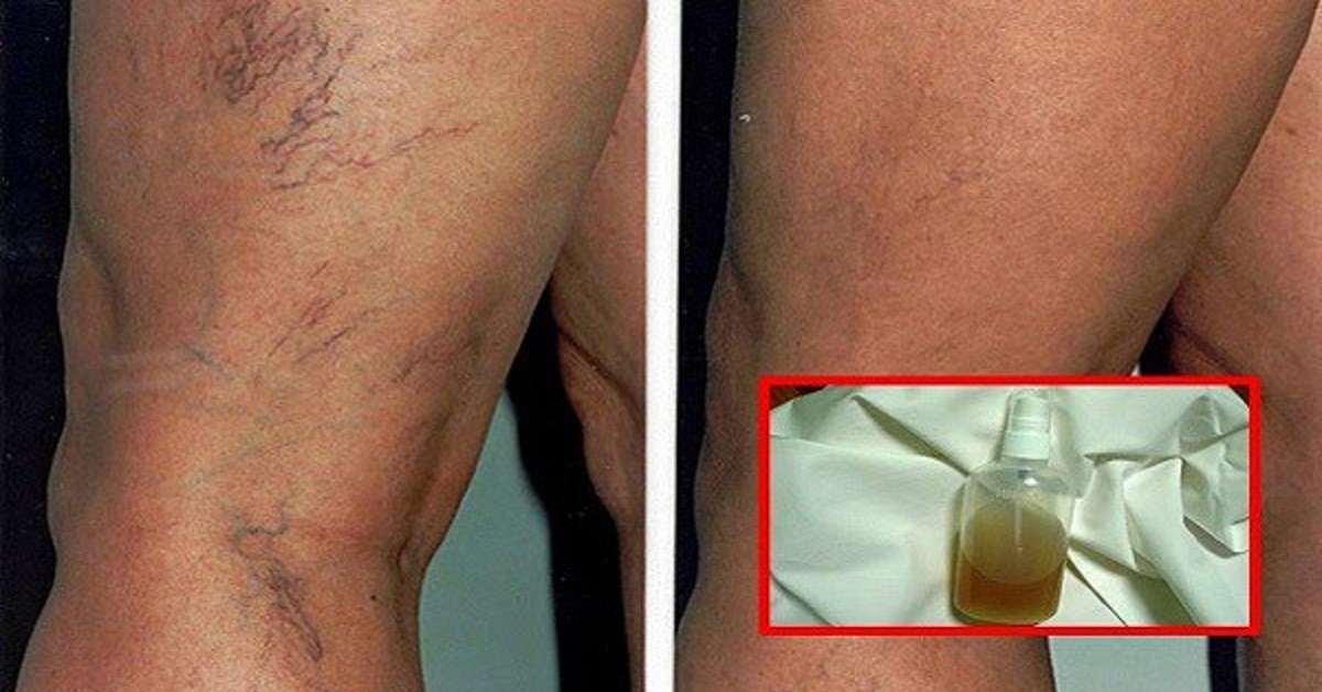 Natural balm: The best way to remove varicose veins and restore the ...