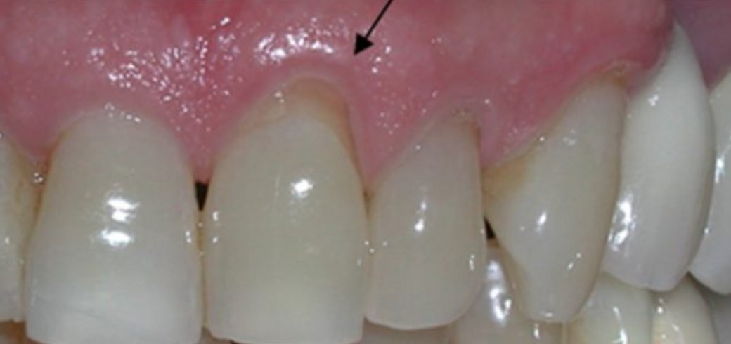 Acute help for receding gums. An effect that even the most expensive ...