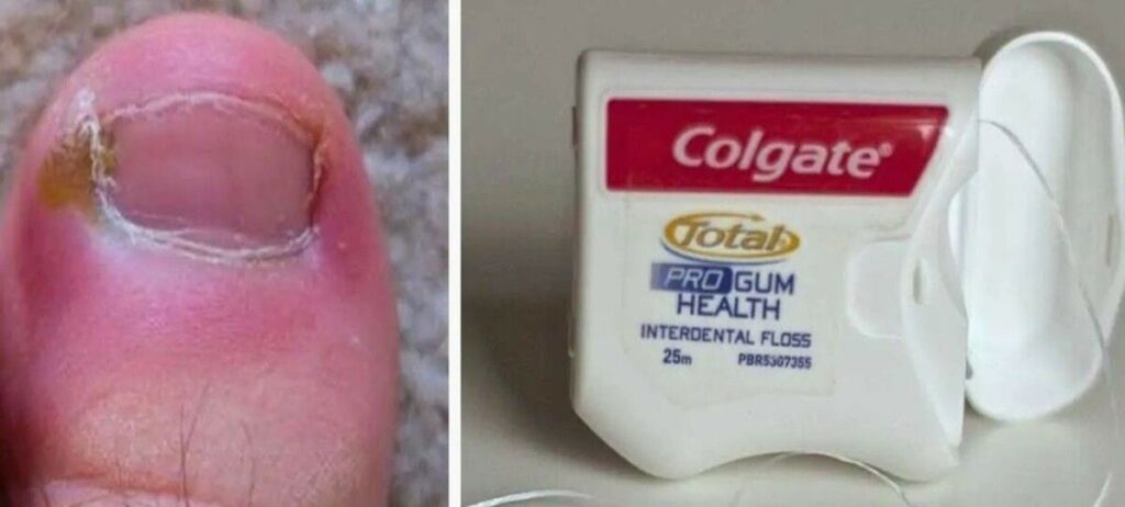 Are you troubled by an ingrown nail on your big toe? We'll show you a ...