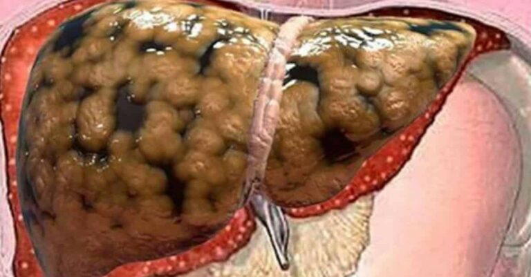 Liver fat can be easily removed using ordinary water thanks to this ...