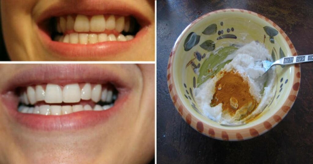 This homemade paste will whiten teeth and eliminate swelling ...