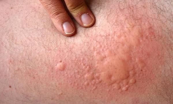 Read: How to easily recognize hives and easily cope with them? Your ...