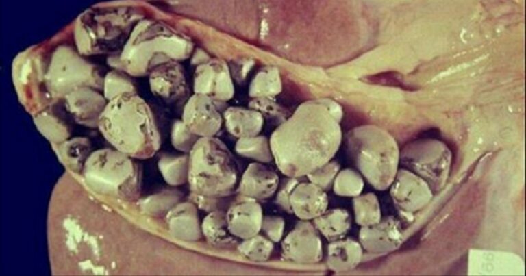 Gallbladder attacks troubled me all the time. Using this method you ...