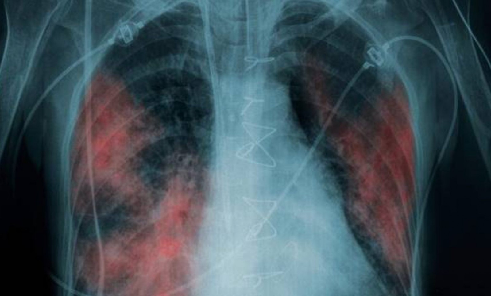 Guide on how to naturally get rid of a respiratory tract infection - i ...