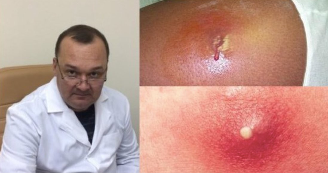 Acute aid for ulcers and abscesses. A great solution for skin problems ...