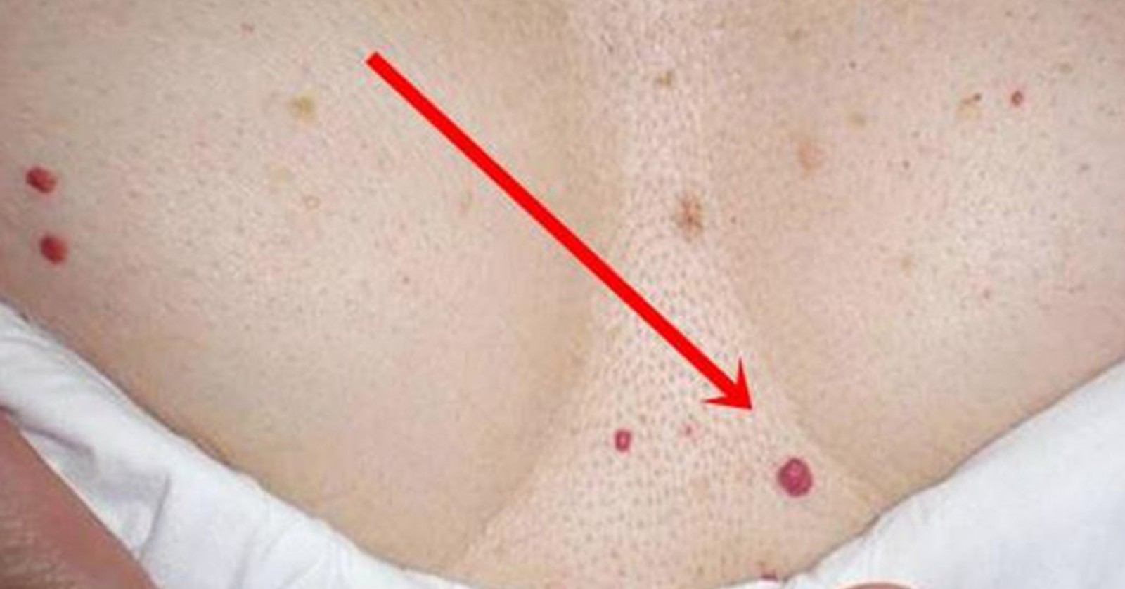 Do you have these red spots on your body? Find out why this is ...