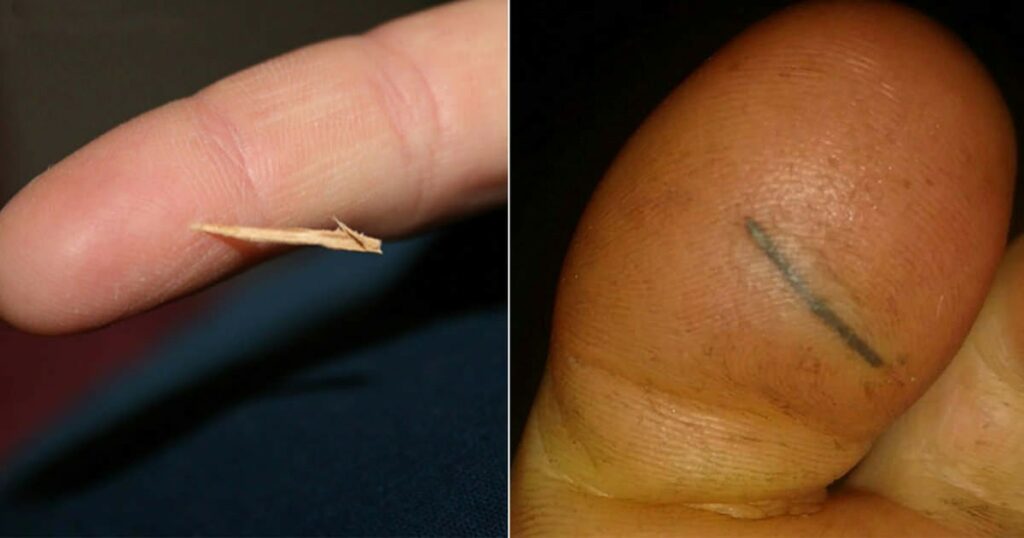 Learn this simple method to remove a splinter - i-Recipe