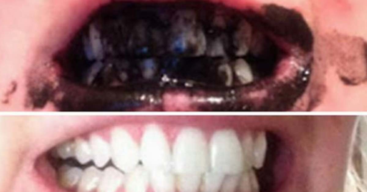 A tried-and-true trick for whiter teeth from our grandmothers - i-Recipe