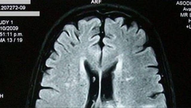 Forgetting is evidence of high intelligence. Scientists have uncovered ...