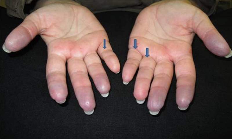 Raynaud's Syndrome: When Winter Cold Causes Serious Problems with the ...