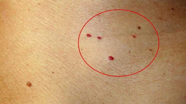 Are red moles appearing on you? They may signal problems with an ...