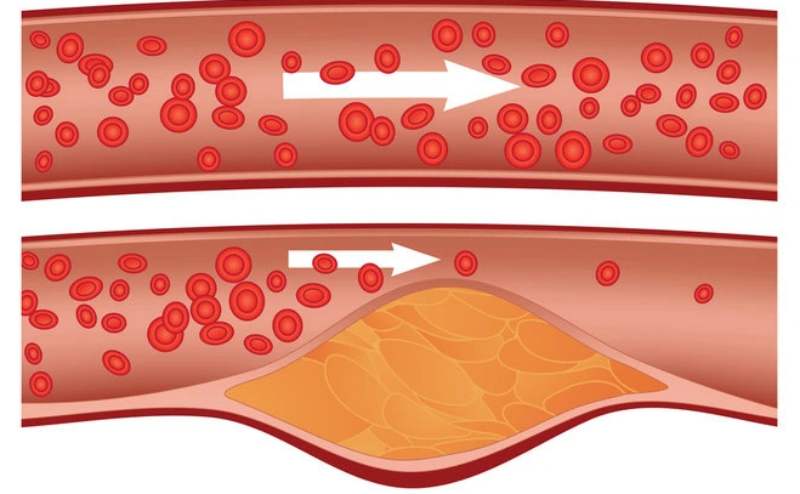 How to detect symptoms of high cholesterol? Five warning signs from the ...