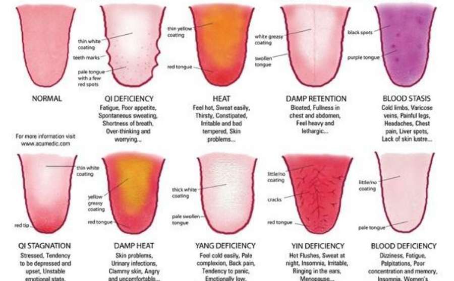 How can the color of your tongue reveal health problems? Discover the ...